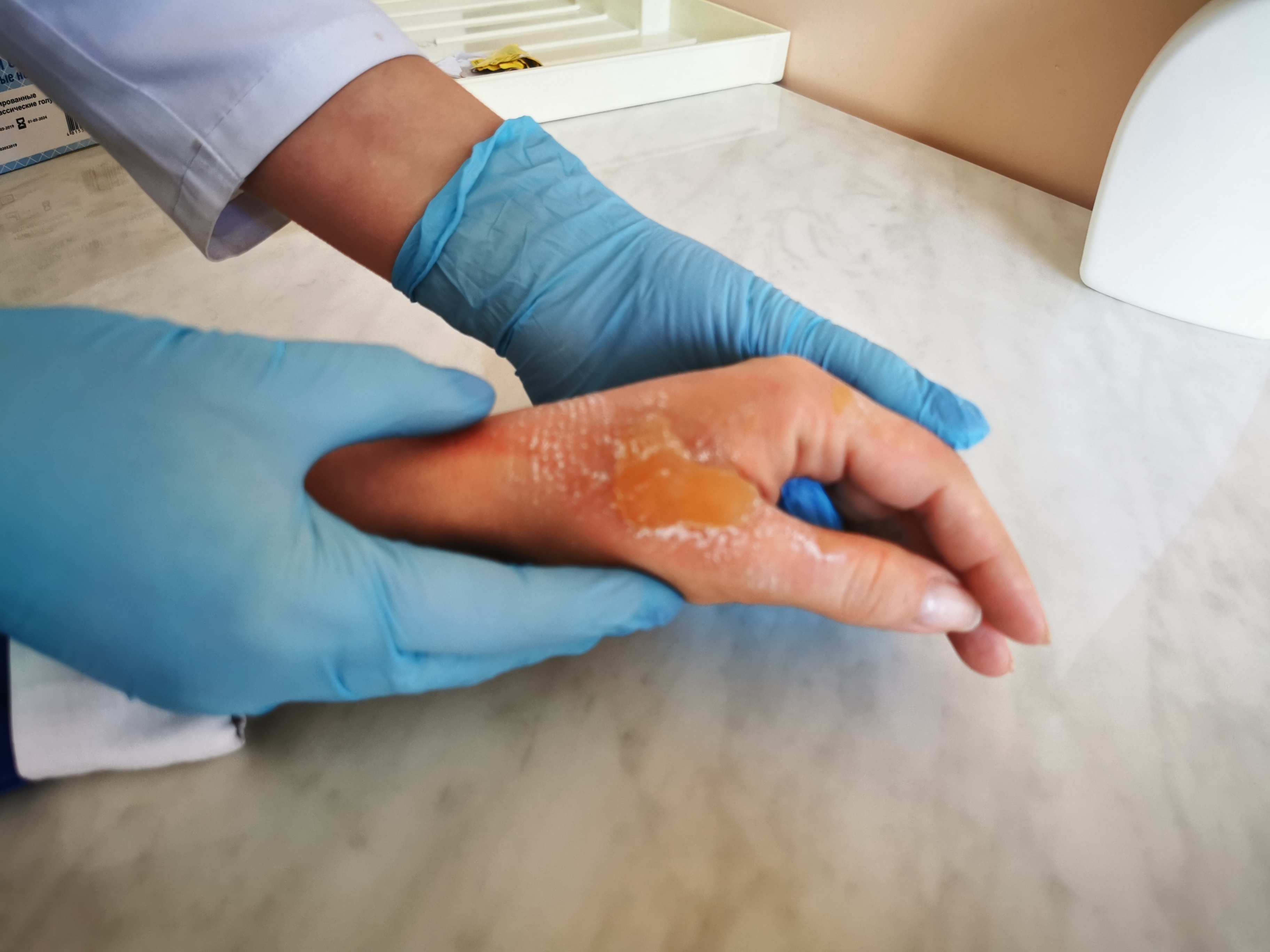 Burn Incidence & Treatment in the U.S. | ABA Burn Data